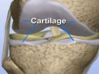 voici-comment-regenerer-le-cartilage-du-genou-340x255-1 - Haustipps